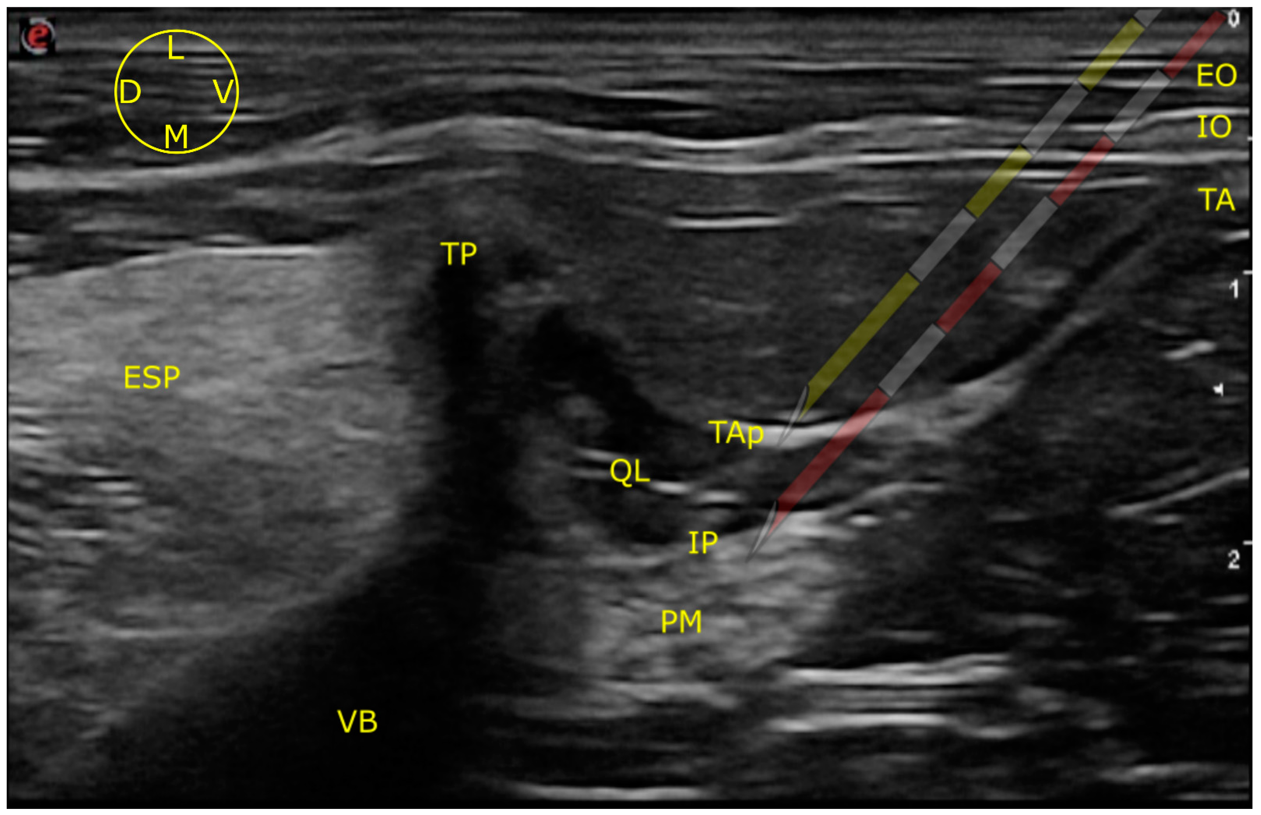 An Ultrasound-Guided Latero-Ventral Approach to Perform the Quadratus ...