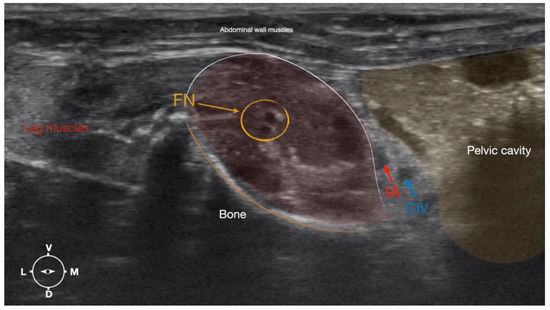 Ultrasound-Guided Block of the Sciatic and the Femoral Nerves in ...