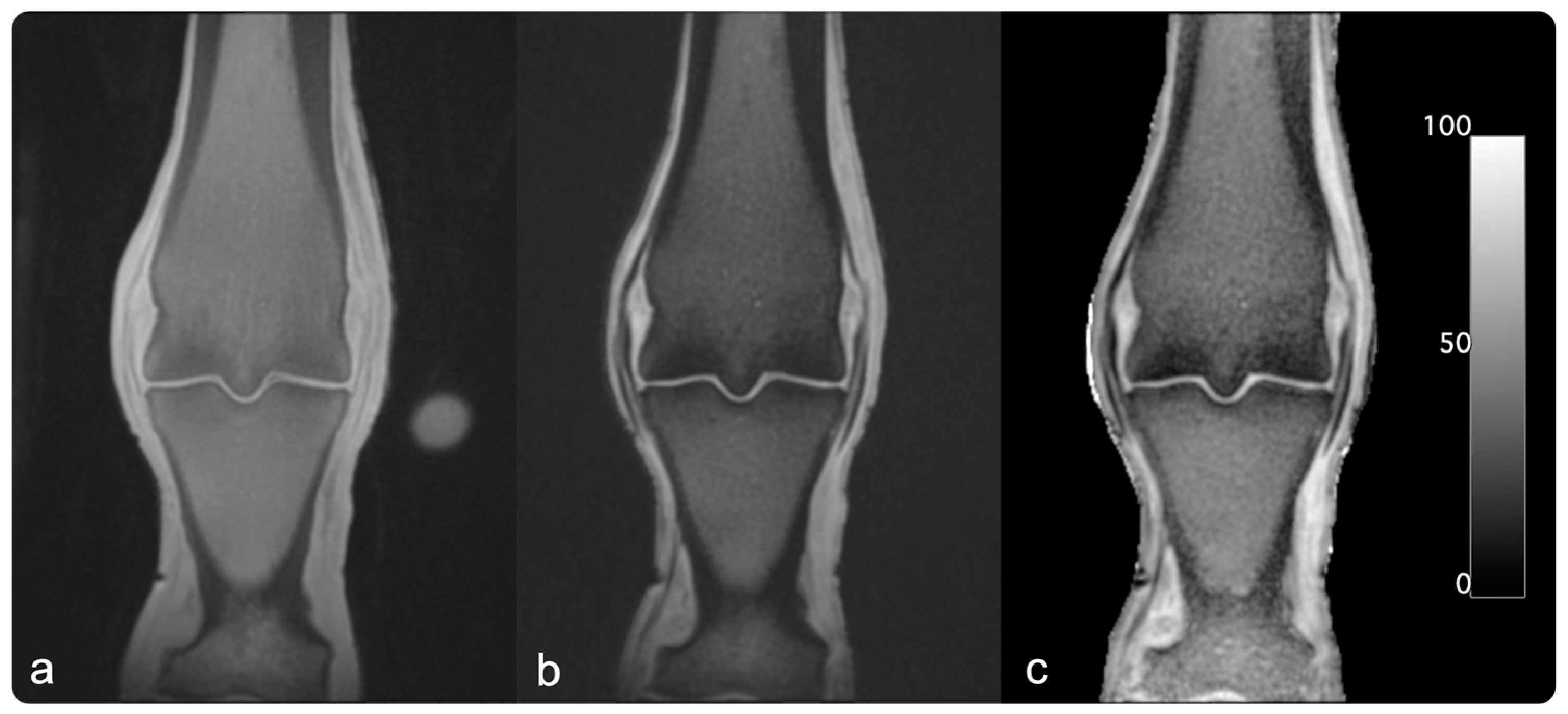 Relationship between CT-Derived Bone Mineral Density and UTE-MR-Derived ...