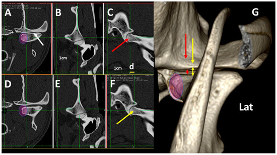 Three-Dimensional Volume Rendering in Computed Tomography for ...