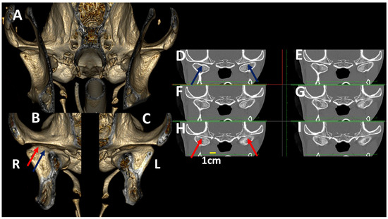 Three-Dimensional Volume Rendering in Computed Tomography for ...