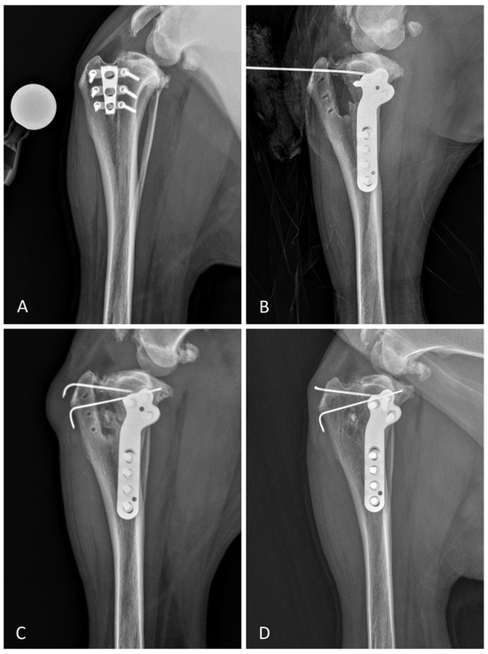 Tibial Plateau Leveling Osteotomy following Tibial Tuberosity ...