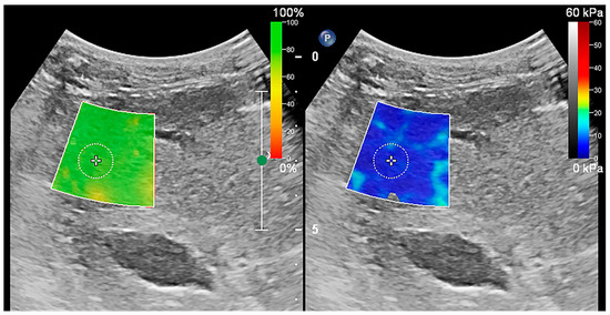 Evaluation of the Feasibility of 2D-SWE to Measure Liver Stiffness in ...