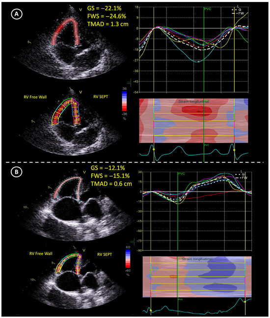 Right Ventricle Strain Assessed by 2-Dimensional Speckle Tracking ...