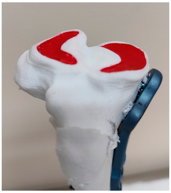 Comparison of the Visibility of Canine Menisci before and after Tibial ...