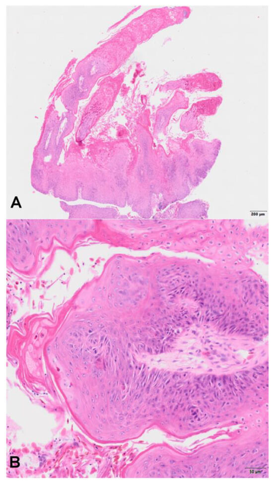 Concurrent Detection of a Papillomatous Lesion and Sequence Reads ...