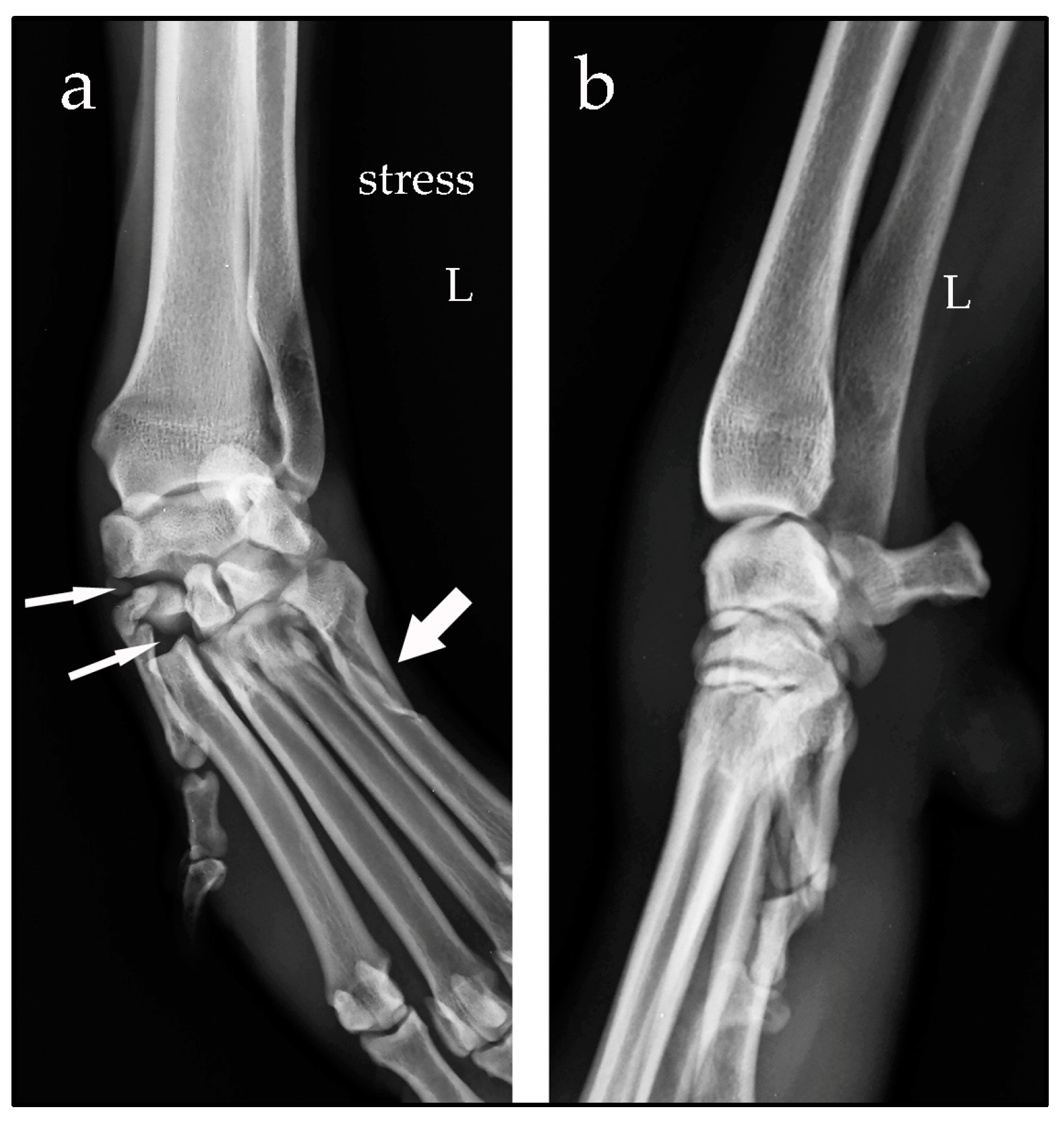 Treatment of Medial Instability of the Carpometacarpal and ...