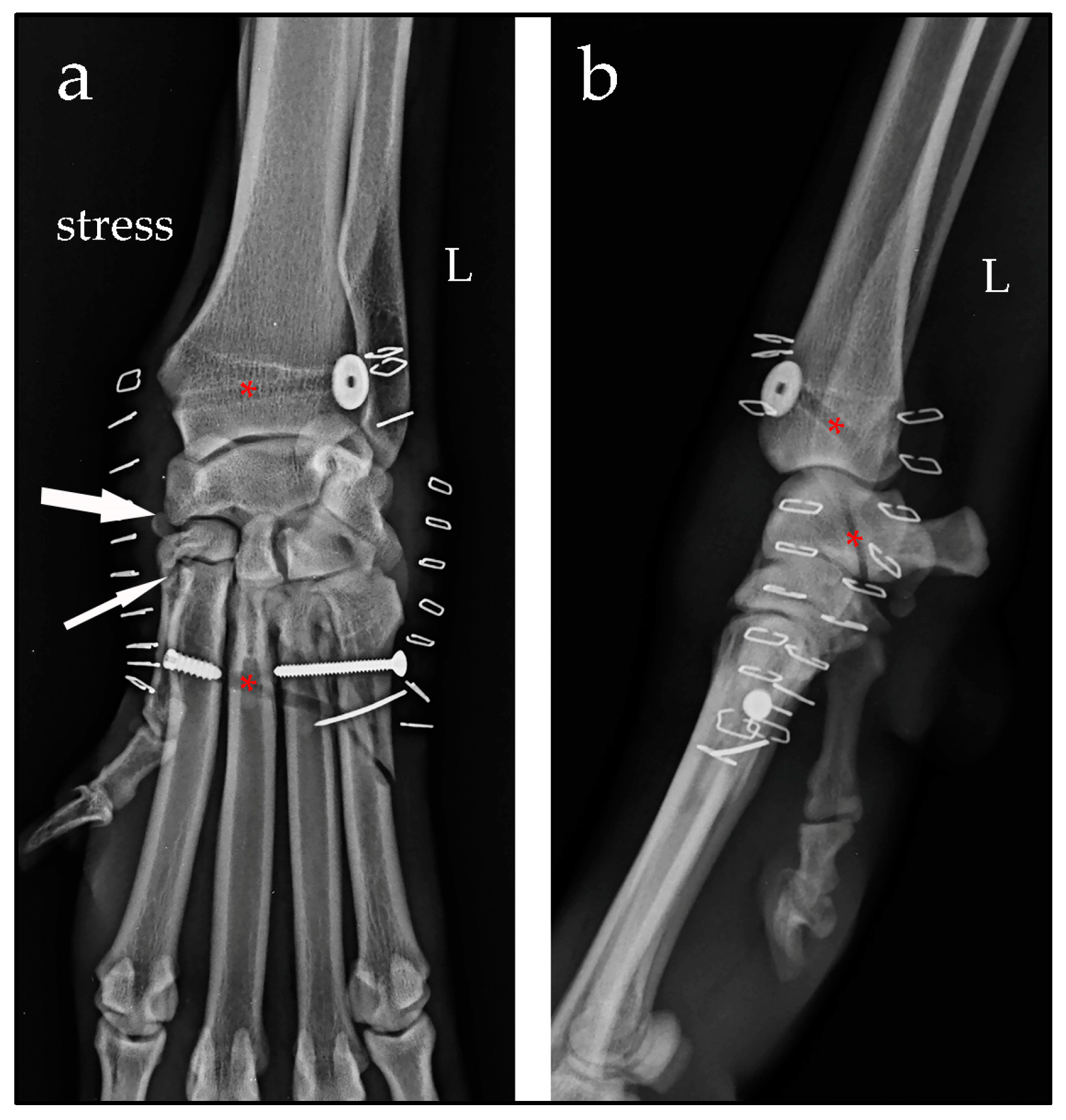 Treatment of Medial Instability of the Carpometacarpal and ...