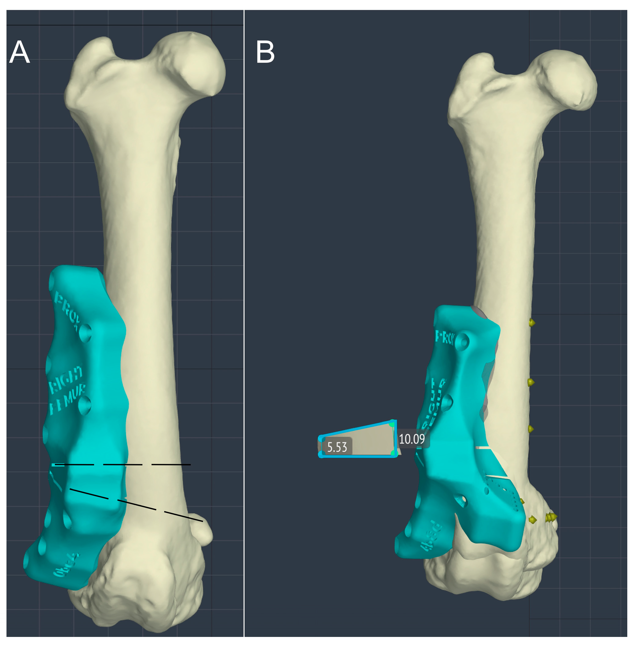 Patient-Specific 3D-Printed Osteotomy Guides and Titanium Plates for ...