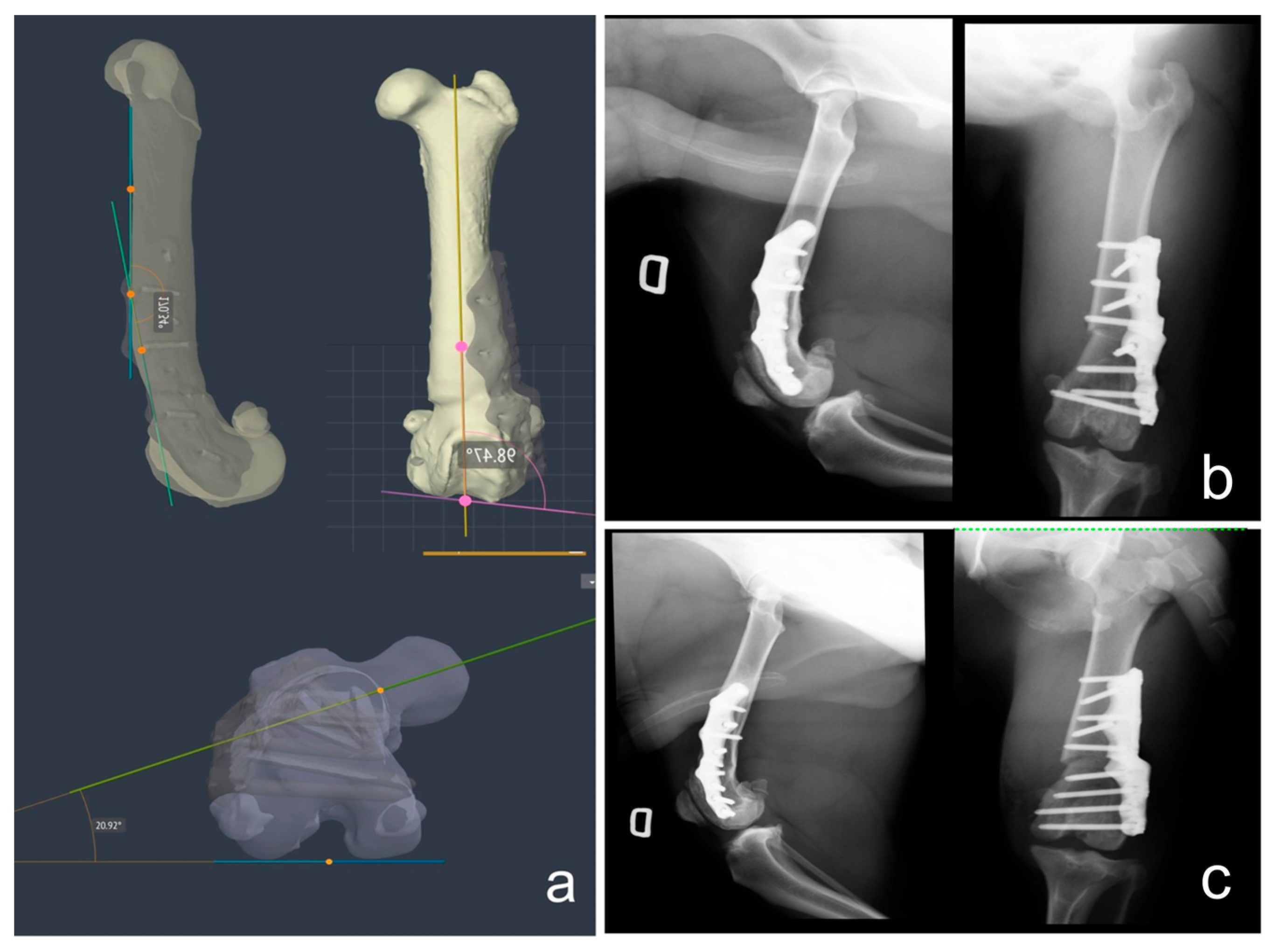 Patient-Specific 3D-Printed Osteotomy Guides and Titanium Plates for ...