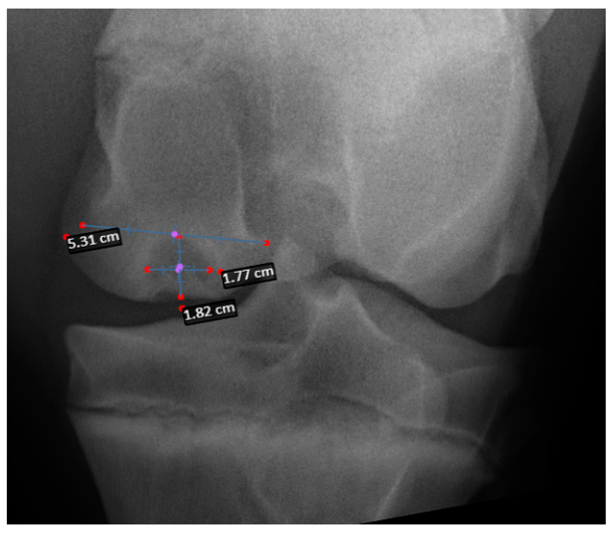 Treatment Comparison for Medial Femoral Condyle Subchondral Cystic ...