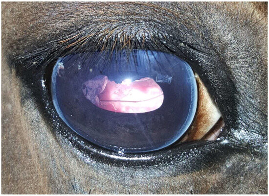 Phacoemulsification Combined with Pars Plana Vitrectomy: Outcome in ...