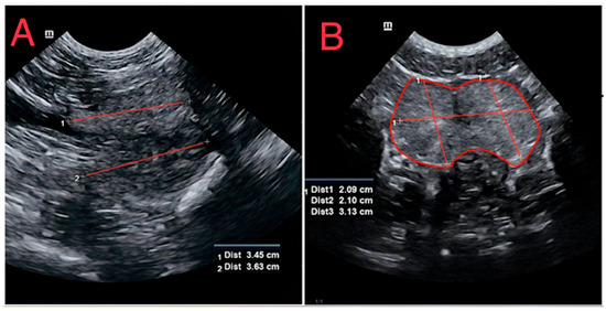 Comparative Evaluation of Diagnostic Methods for Subclinical Benign ...