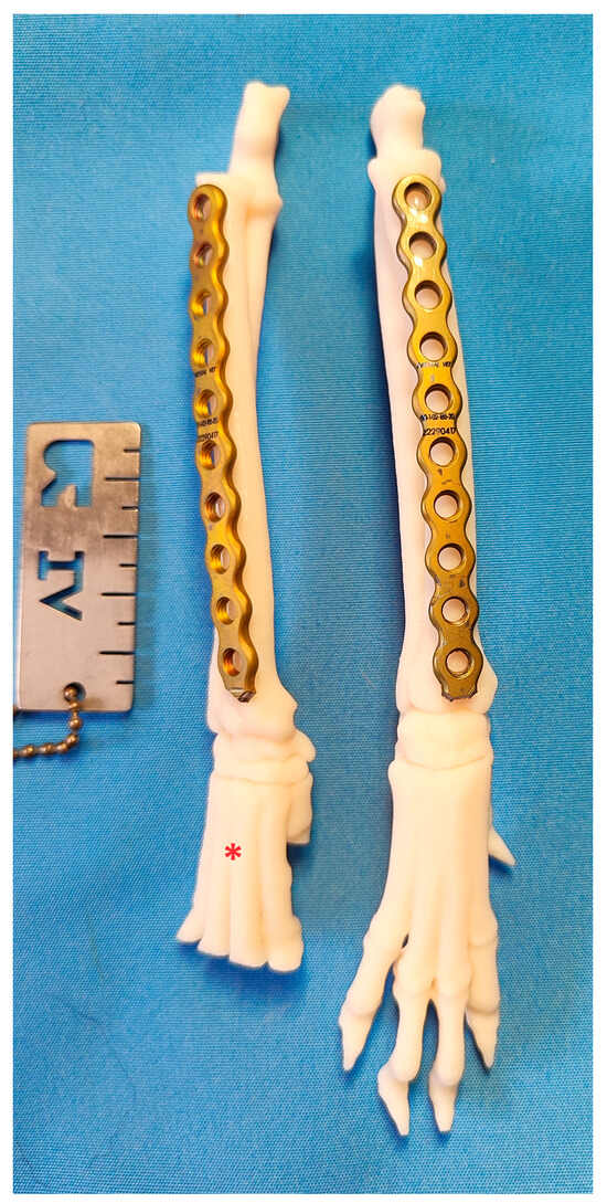 Minimally Invasive Plate Osteosynthesis (MIPO) of Comminuted Radial ...