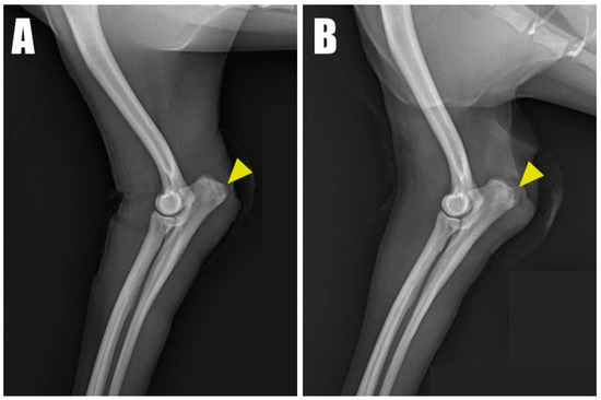 Reconstruction of Bilateral Chronic Triceps Brachii Tendon Disruption ...