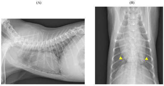 Surgical Correction of Infundibular Muscular Ventricular Septal Defect ...