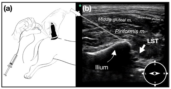 Ultrasound-Guided Greater Ischiatic Notch Plane Block Combined with the ...