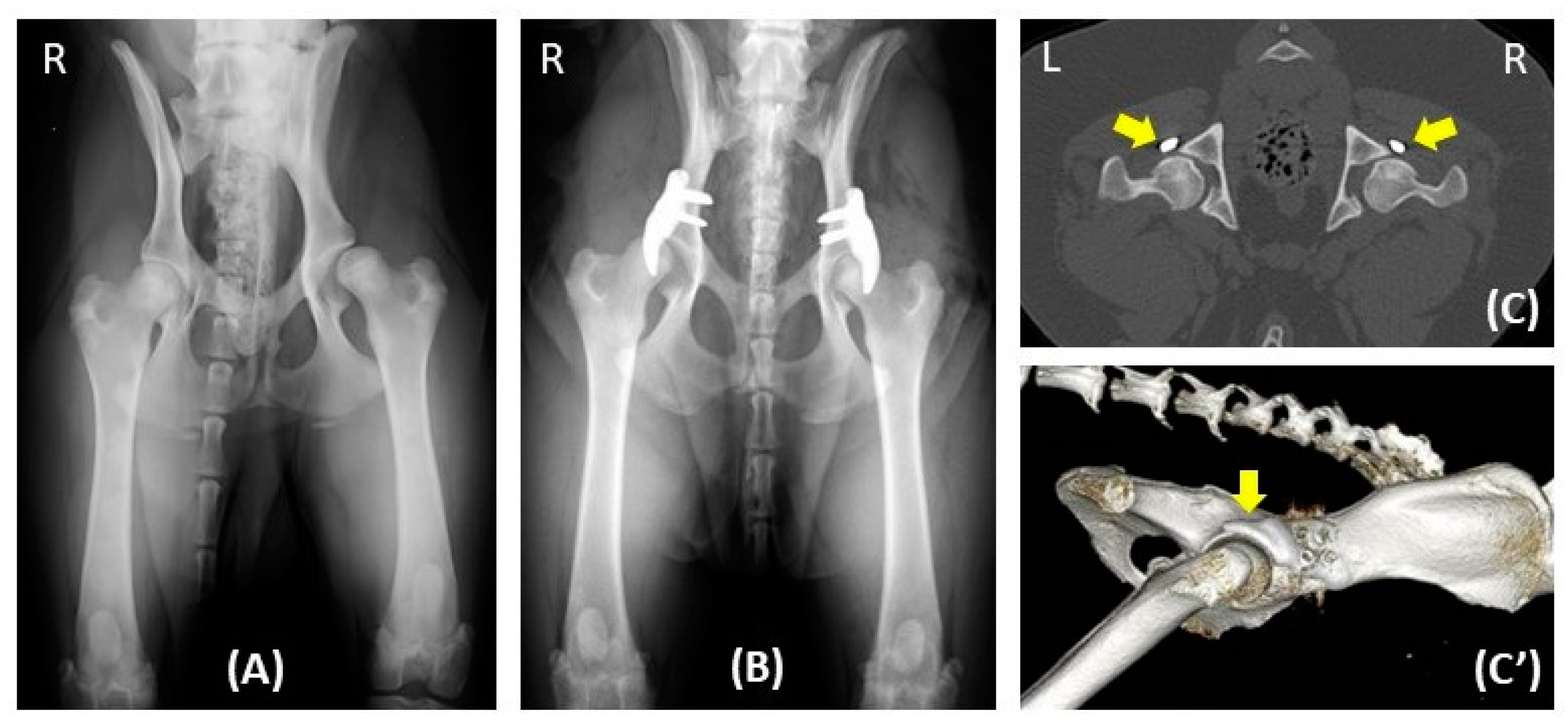 Outcome One Year after Acetabular Rim Extension Using a Customized ...