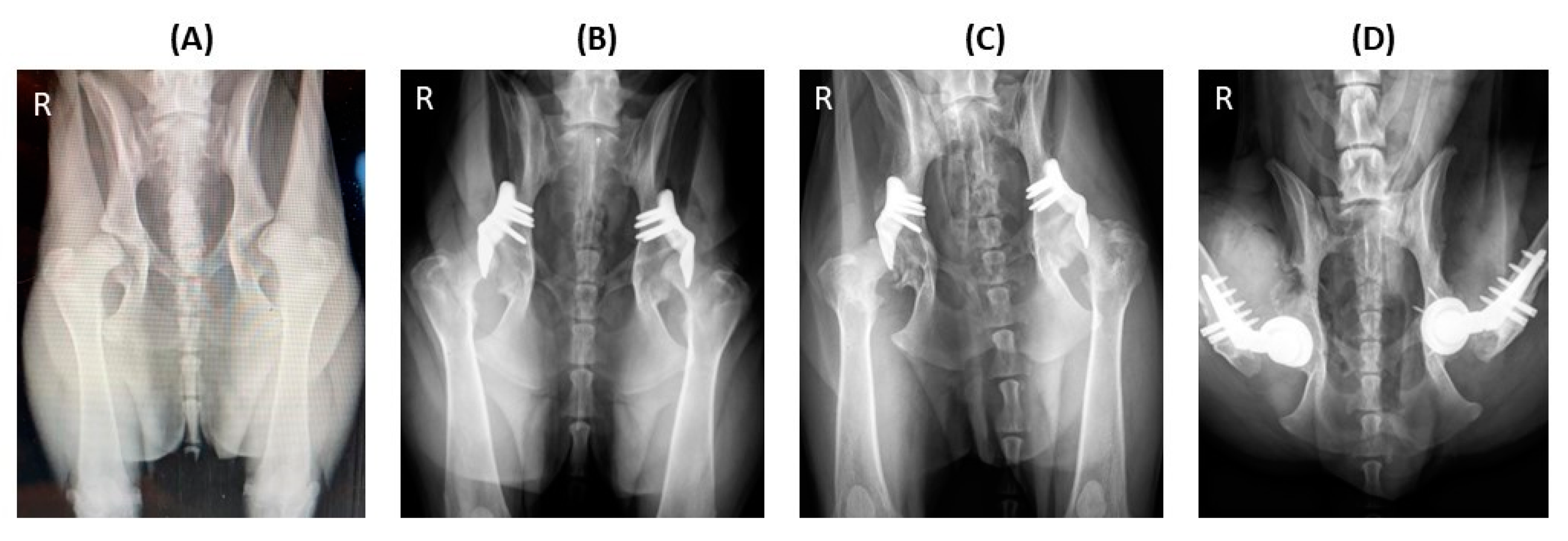 Outcome One Year after Acetabular Rim Extension Using a Customized ...
