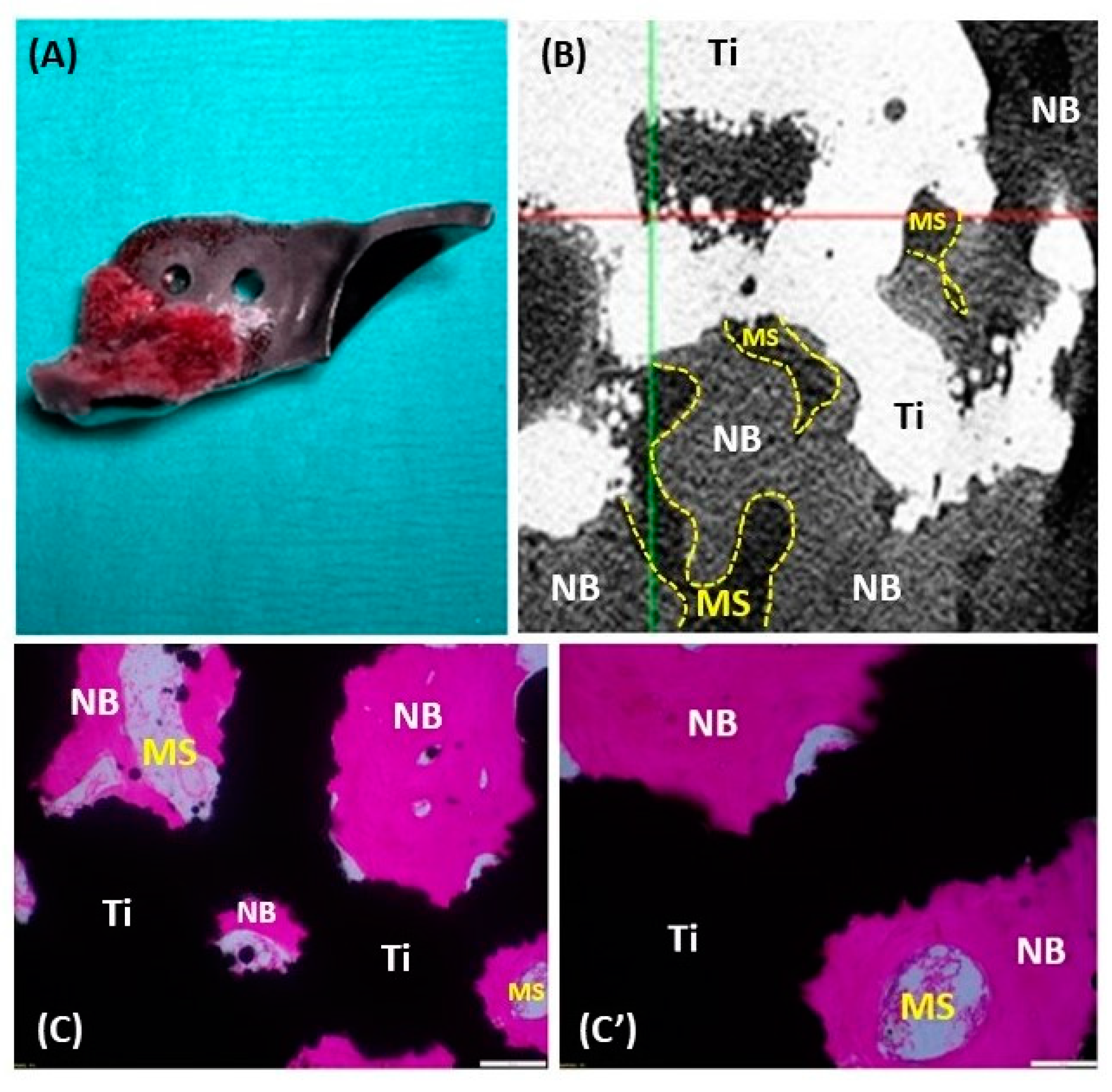 Outcome One Year after Acetabular Rim Extension Using a Customized ...