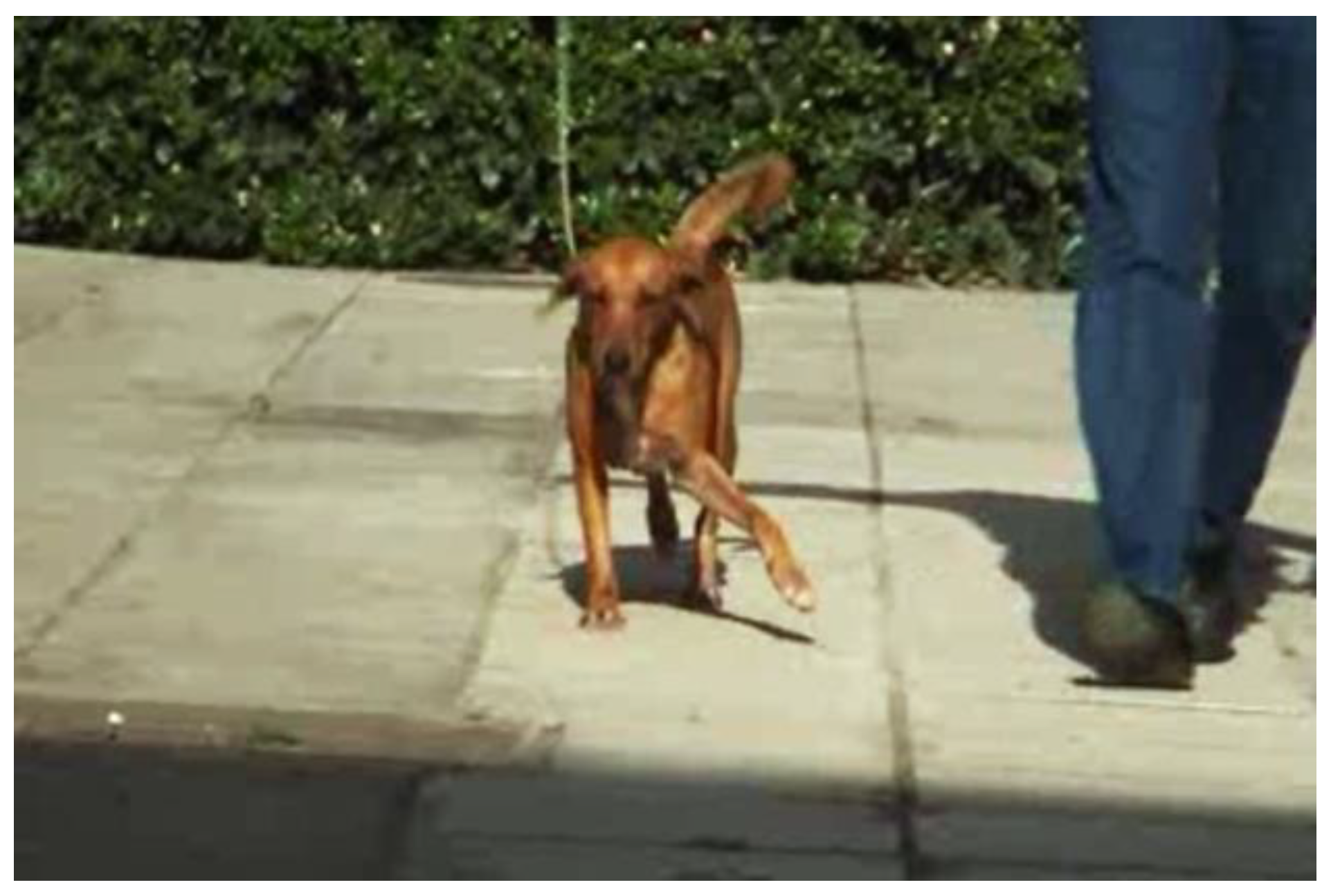 Fibrotic Contracture of the Infraspinatus Muscle with or without ...