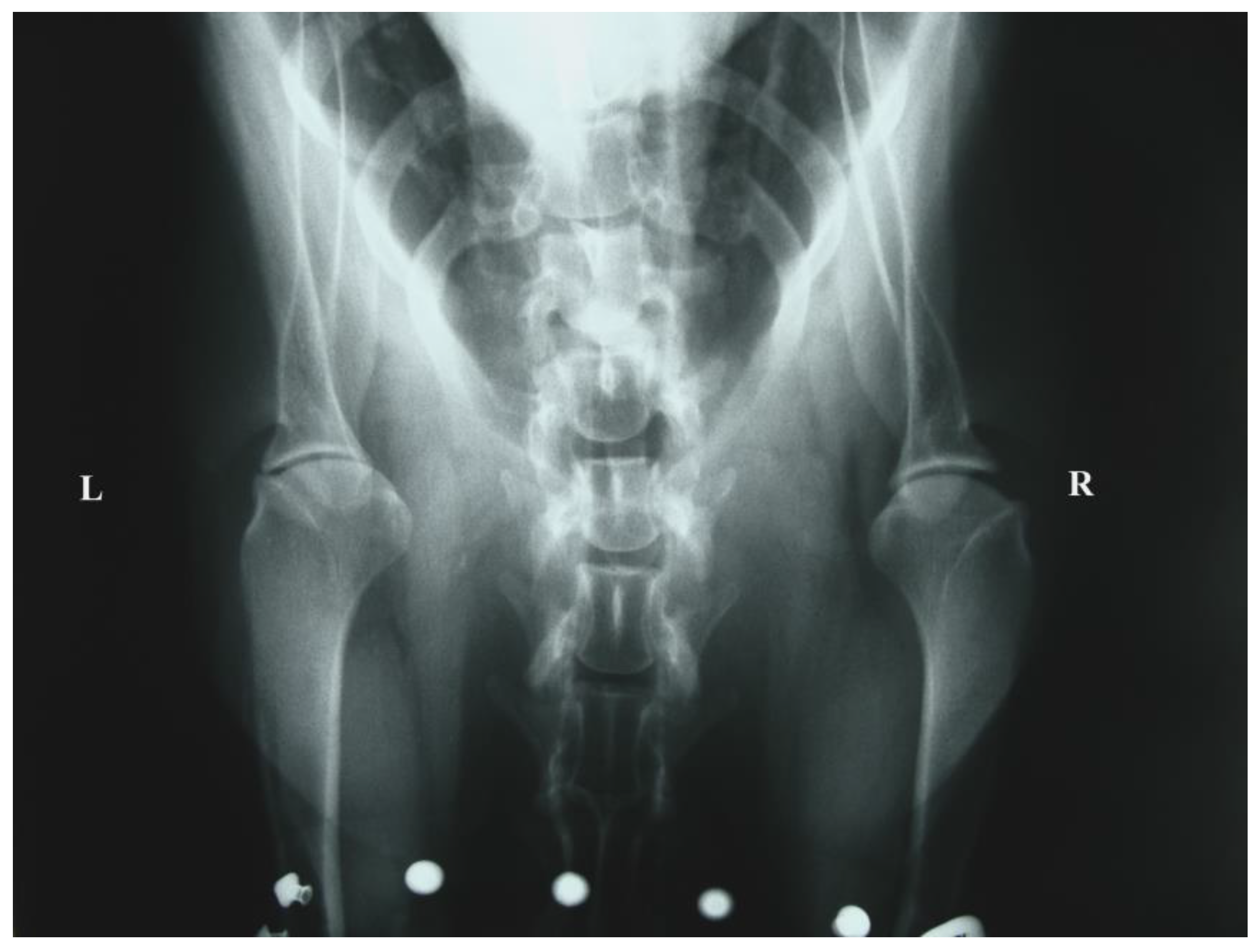 Fibrotic Contracture of the Infraspinatus Muscle with or without ...