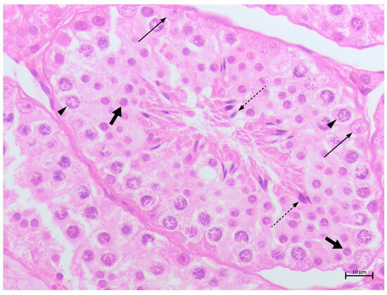 Preliminary Evidence of the Possible Roles of the Ferritinophagy-Iron ...