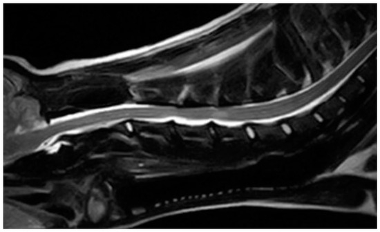 Double Cervical Adjacent Hydrated Nucleus Pulposus Extrusion (HNPE) in ...
