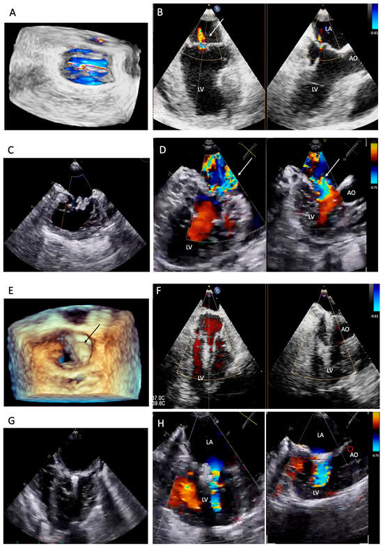 Transcatheter Edge-to-Edge Repair of the Mitral Valve in Four Dogs ...