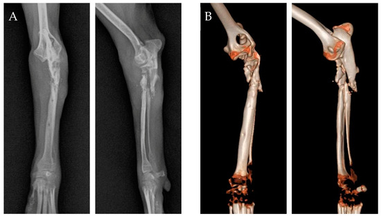 Application of Hybrid External Skeletal Fixation with Bone Tissue ...
