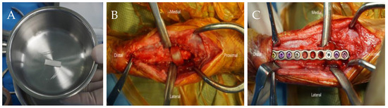 Application of Hybrid External Skeletal Fixation with Bone Tissue ...