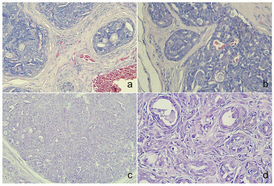 Endocrine Mucin-Producing Sweat Gland Carcinoma (EMPSGC) in a Dog ...