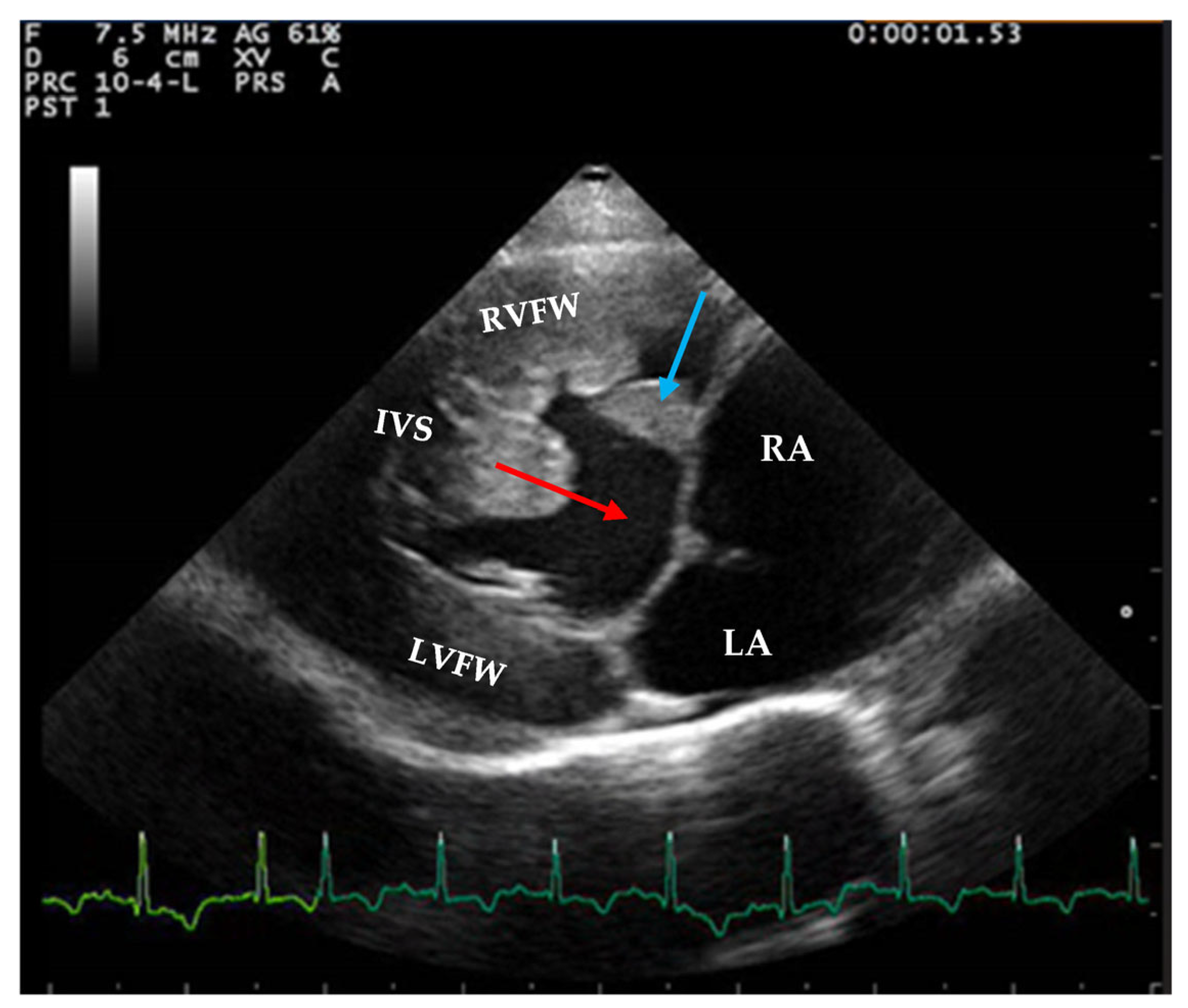 Concurrent Persistent Truncus Arteriosus and Left Atrial Diverticulum ...