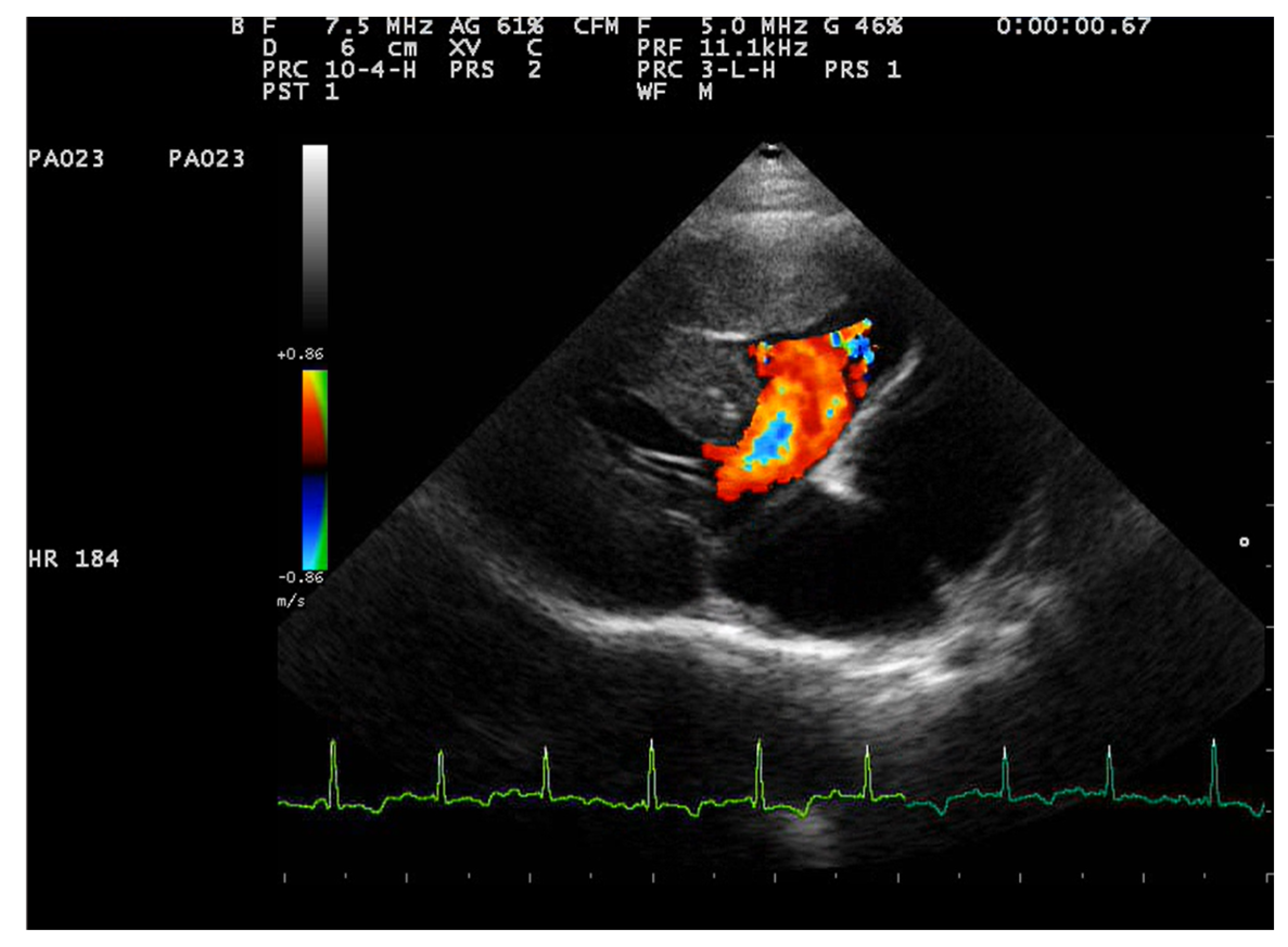Concurrent Persistent Truncus Arteriosus and Left Atrial Diverticulum ...