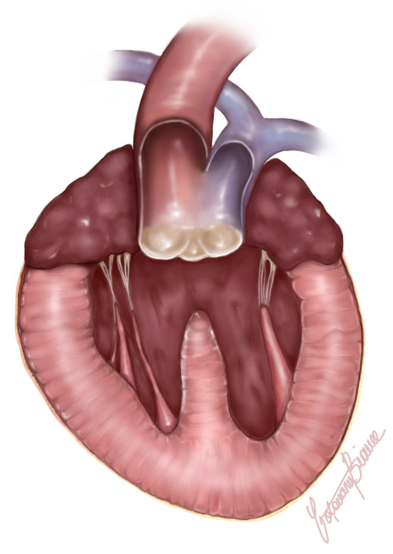 Concurrent Persistent Truncus Arteriosus and Left Atrial Diverticulum ...