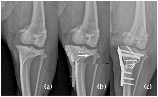 Simultaneous Modified Tibial Plateau Leveling Osteotomy and Tibial ...