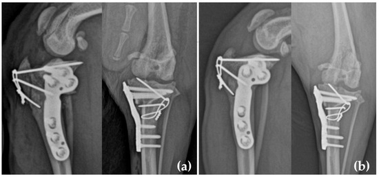Simultaneous Modified Tibial Plateau Leveling Osteotomy and Tibial ...