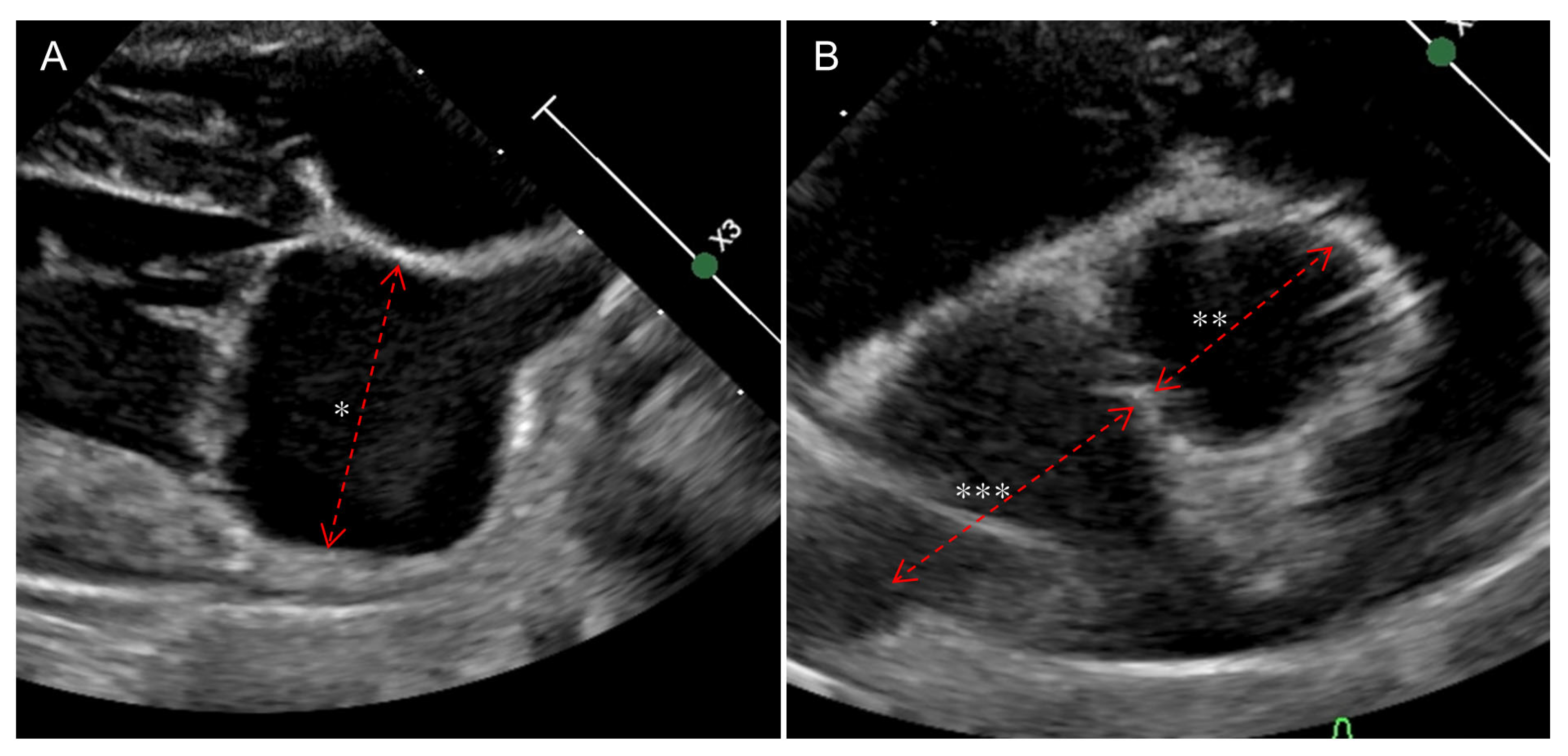 A Novel Echocardiographic Index (Modified-Left-Atrium-to-Aorta Ratio ...