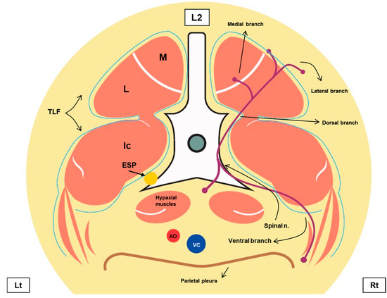 Description of Ultrasound-Guided Lumbar Erector Spinae Plane (ESP ...