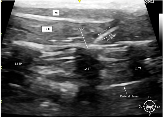 Description of Ultrasound-Guided Lumbar Erector Spinae Plane (ESP ...