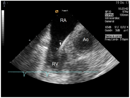 Pacemaker Lead Endocarditis Investigated with Intracardiac ...