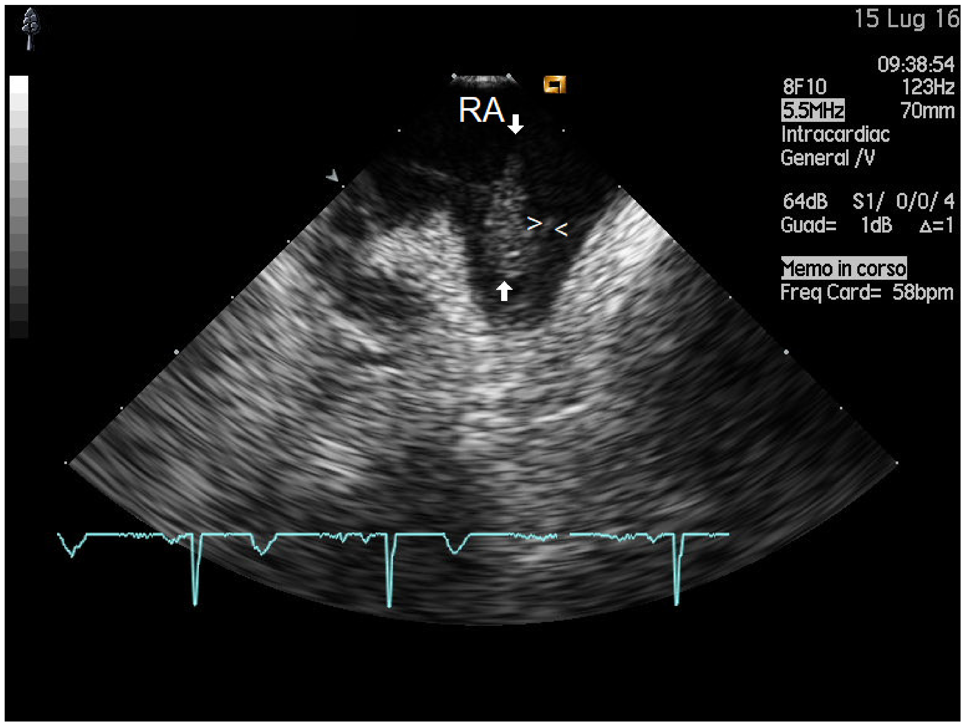 Pacemaker Lead Endocarditis Investigated with Intracardiac ...