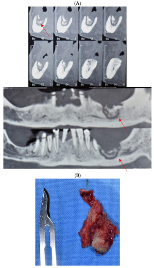 Conservative Management of Medication-Related Osteonecrosis of the Jaws ...