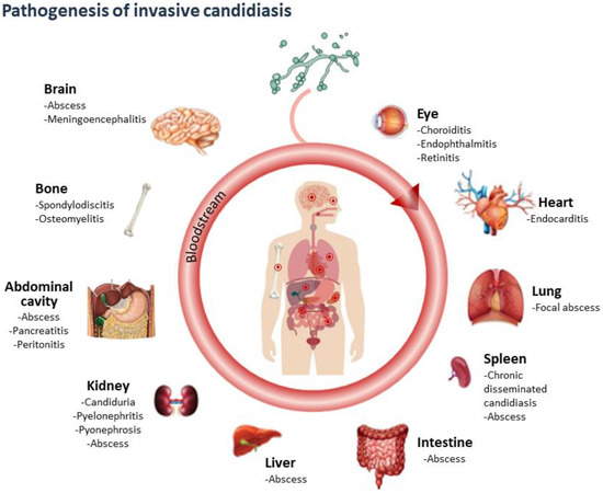 Invasive Candidiasis: Update and Current Challenges in the Management of This Mycosis in South ...