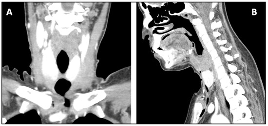 Surgical Excision of Unusual Sacked Neck and Mediastinum Abscess of ...