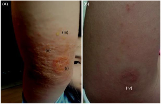 Staphylococcus Infection: Relapsing Atopic Dermatitis and Microbial ...