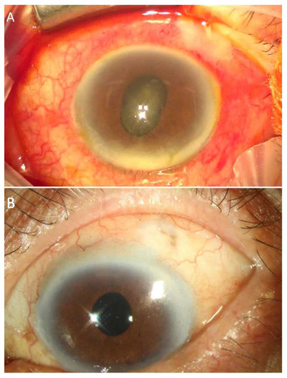 Late-Onset Bleb-Related Endophthalmitis Caused by Moraxella ...