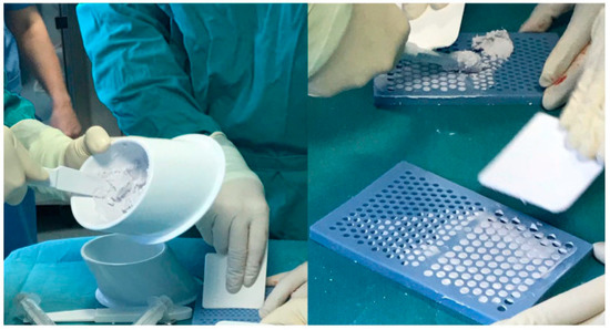 Local Antibiotic Delivery Options in Prosthetic Joint Infection