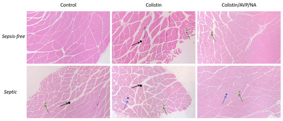 Critical-Illness: Combined Effects of Colistin and Vasoactive Drugs: A ...