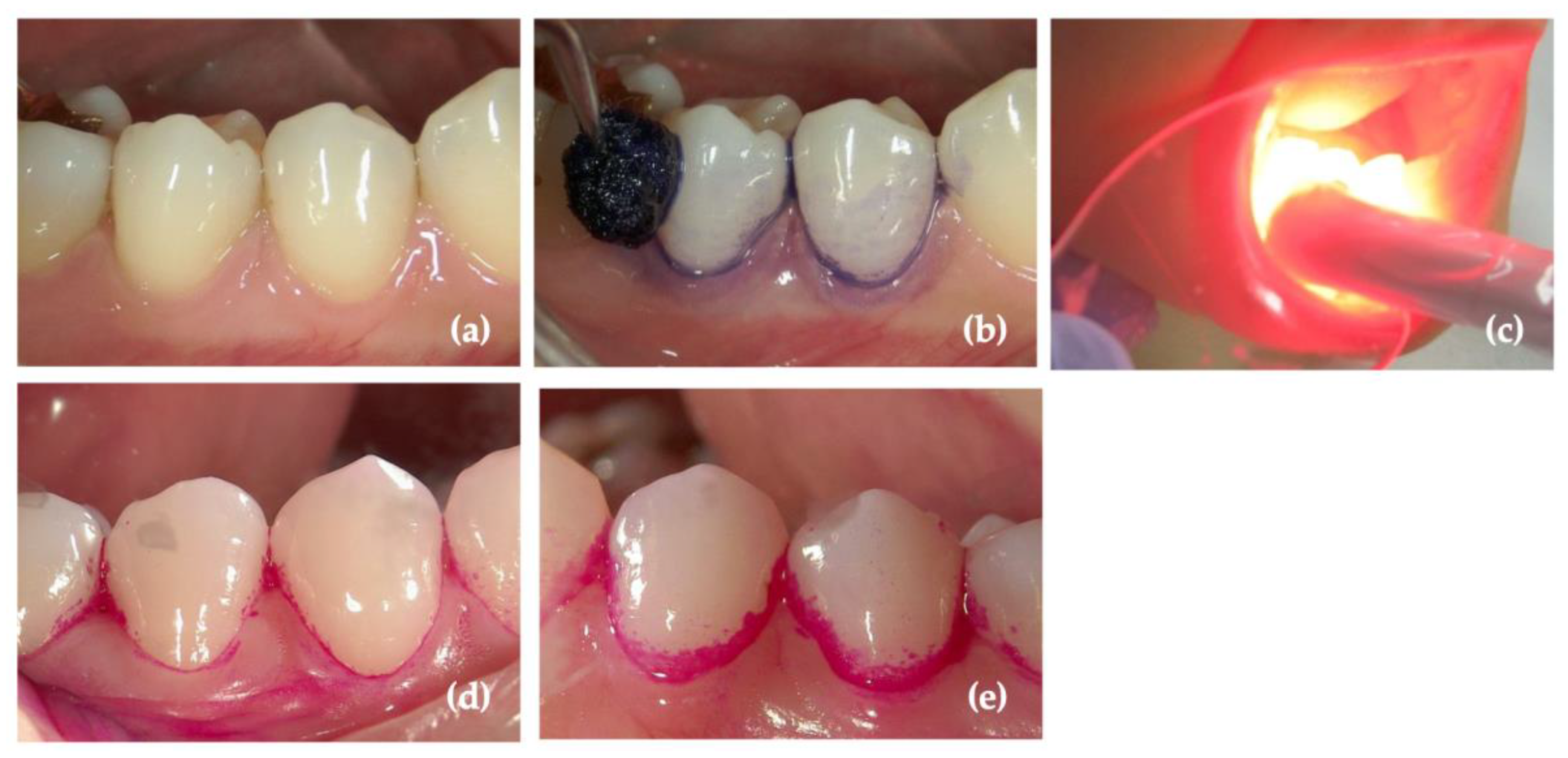 Application of Different Wavelengths of LED Lights in Antimicrobial ...